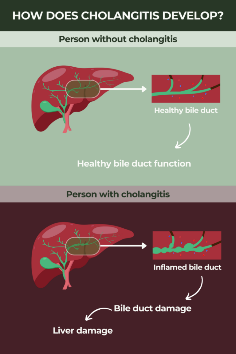 Cholangitis Causes Symptoms Treatment And More