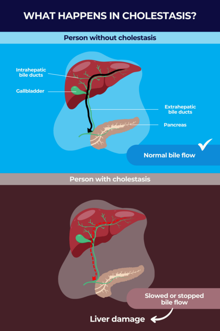 Cholestasis: Causes, symptoms, pregnancy, and more | Liver Disease News
