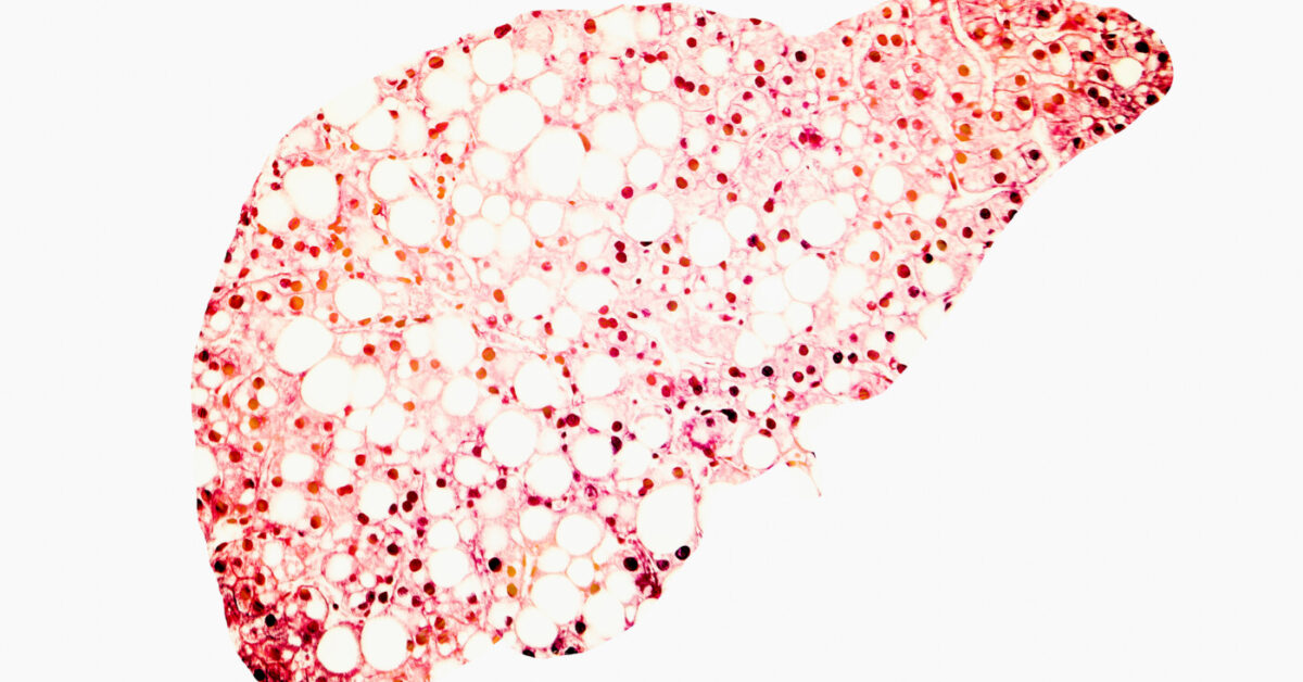 MASH and fibrosis | Liver Disease News
